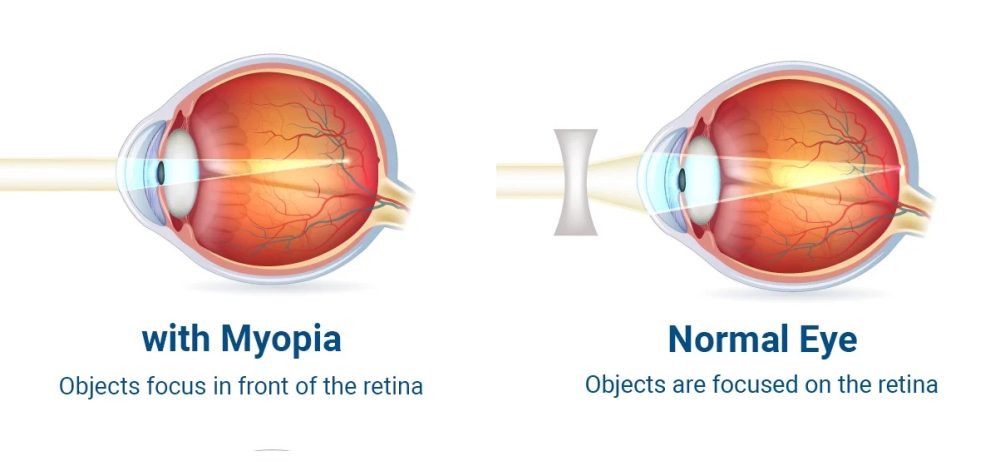 Smile Pro - 香港近視及老花眼中心
